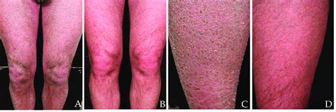 Ichthyosis‐like Atopic Dermatitis Before A And C And After B And D Download Scientific