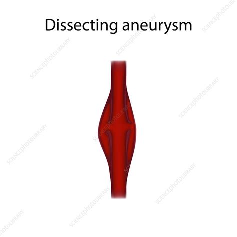 Dissecting Aneurysm