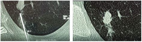 A Ct Scan Showing The Plug Deployment Download Scientific Diagram