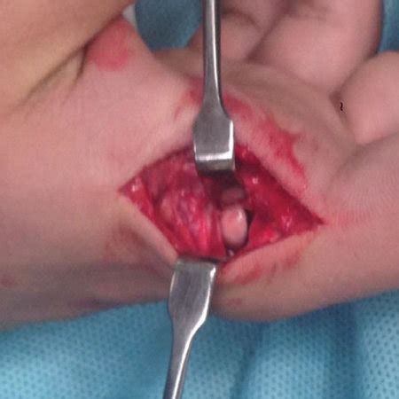 Lateral Approach On The MCP Joint Download Scientific Diagram