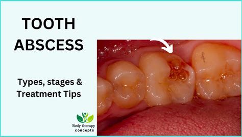 Tooth Abscess Types Stages And Treatment Everything You Need To Know