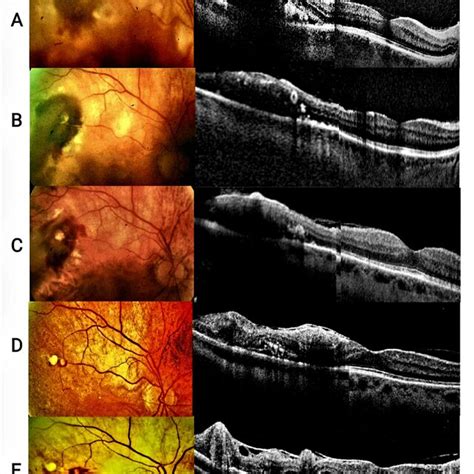 A Schematic Diagram Showing Disease Progression Time Line Monthyear