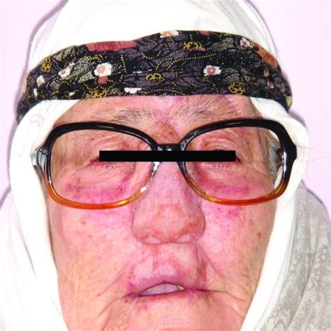 Pdf Nasal Prosthesis Rehabilitation After Partial Rhinectomy A Clinical Report