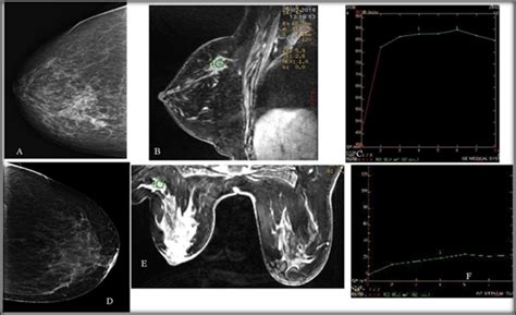 A Patient 8 Invasive Ductal Cell Carcinoma Mammogram Right Breast B