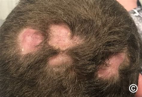 Dissecting Cellulitis