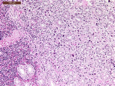 Pathology Outlines Diffuse Poorly Cohesive Type Adenocarcinoma