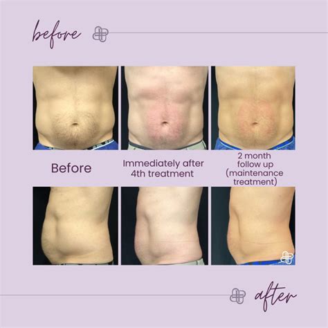 What Is Emsculpt Neo Ultimate Body Sculpting Solution Pamper Me