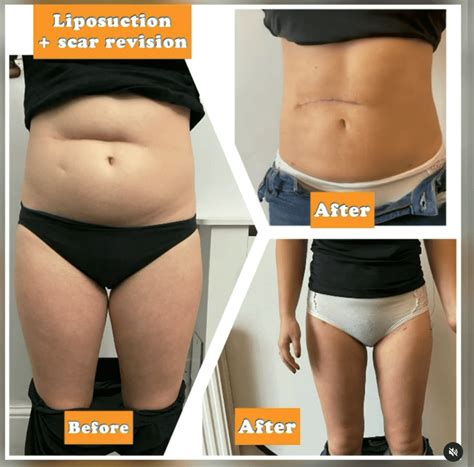 Liposuction Scars
