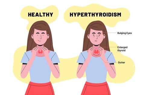 Hyperthyroidism Symptoms Causes And Treatment