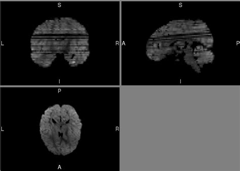 Dti Quality Control Part 1 Acquisition Diffusion Imaging