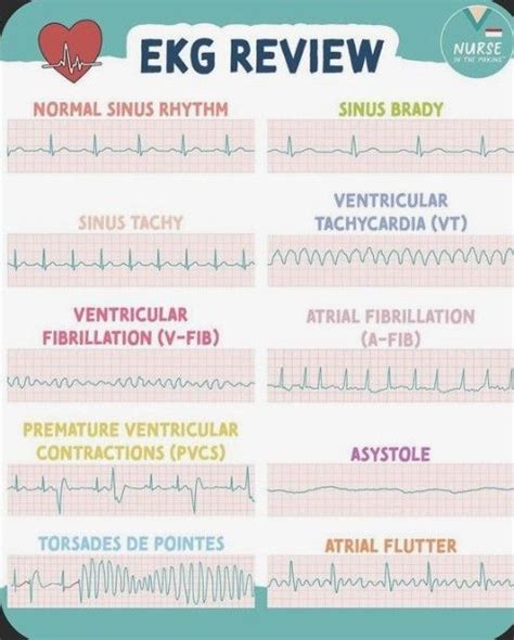Ekg Interpretation Cheat Sheet Free Download Artofit