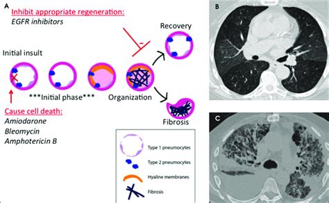 Pathophysiology Of Diffuse Alveolar Damage A In A Healthy Alveolus Download Scientific