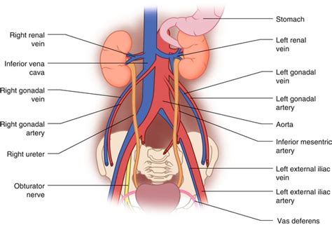 Retroperitoneal Node Dissection Oncohema Key
