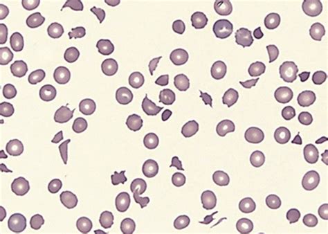 Thrombocytopenic Purpura