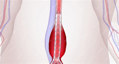 premium photo a stent graft is a thin metal mesh with a fabric