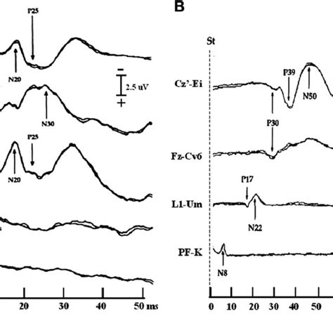 Waveforms Of Median Nerve A And Tibial Nerve B Seps Using Montages