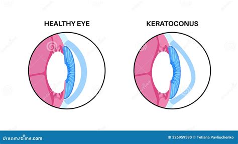Cataract Eye Disease Vector Illustration 327490914