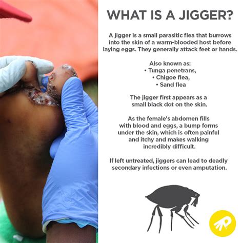 Jigger Bug Removal