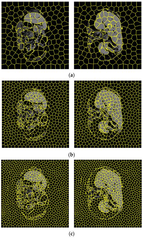 Sensors Free Full Text Automatic Liver Tumor Segmentation From Ct