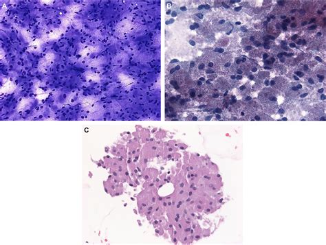 Granular Cell Tumor Cytology