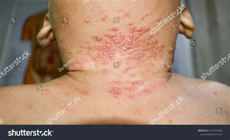 Staphylococcal Skin Infection