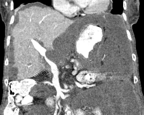 Liver Atlas Diagnosis Metastasis Ovarian Cancer