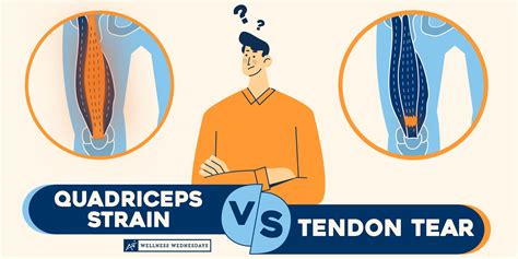 Quadriceps Tendon Tear Vs Quad Strain Airrosti