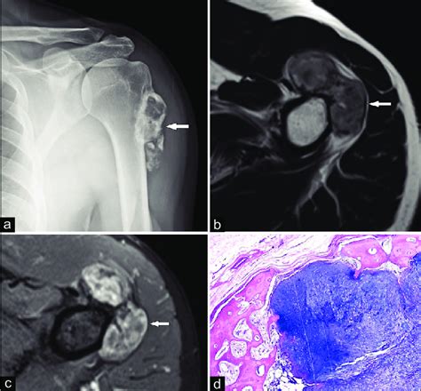 A 40 Year Old Male Presented With Swelling In The Proximal Left Arm