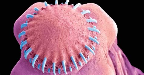 Grim X Ray Shows Man Riddled With Zombie Tapeworms World News
