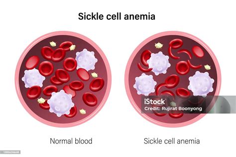 Anemia Sel Sabit Perbedaan Emia Sel Sabit Darah Dan Darah Normal Sel Darah Merah Sel Darah Putih