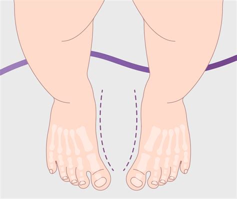 Metatarsus Adductus Causes Symptoms Treatment