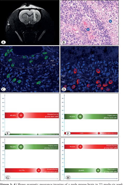 Figure 3 From Development Of Glioblastoma From Stem Cells To A Full