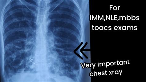 Chest X Ray Of Bronchiectasis At Louise Rizo Blog