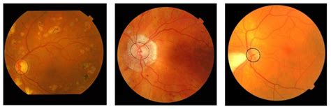 Localization And Segmentation Of Optic Disc In Retinal Images Using Circular Hough Transform And