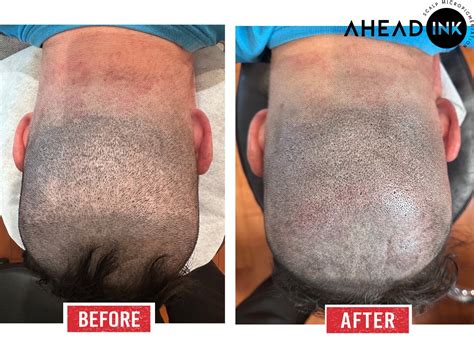Fue Transplant Scar Camouflage New Jerseynew York Scalp
