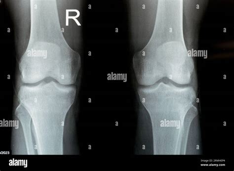 Plain X Ray Of Both Right And Left Knee Joints With Lower Part Of Femur