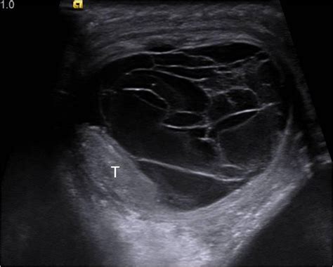 Idiopathic Infant Pyocele Eurorad