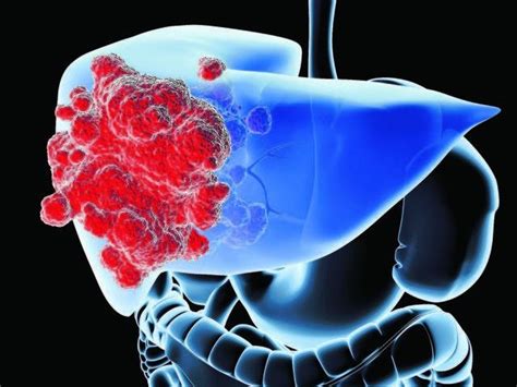 Hepatitis B Igm Anti Core Estudios Analíticos Aplicados A La Clínica