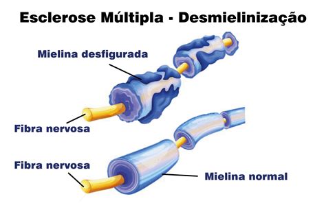 Esclerose MÚltipla Canpp