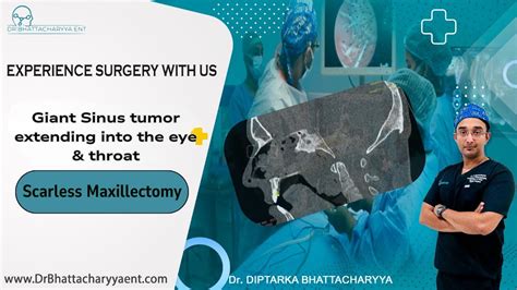 Giant Sinus Tumor Removal Surgery By Maxillectomy Experience Surgery