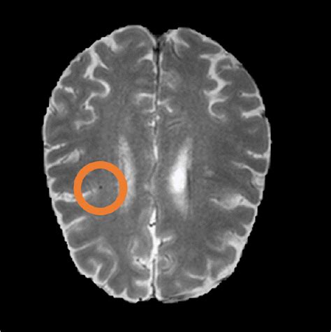 Mixmicrobleednet Segmentation Of Cerebral Microbleeds Using Nnu Net
