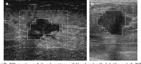 Figure 1 From Automated Segmentation Of Ultrasonic Breast Lesions Using