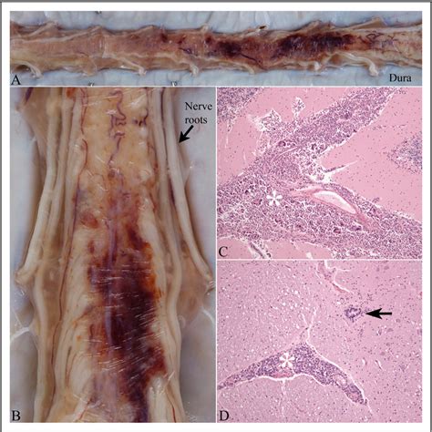 Figure 3 From Intrathecal Methotrexate Toxicity Resulting In Brain Death Due To Generalized