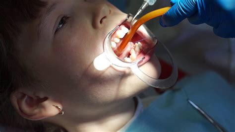 Короткая уздечка языка коррекция или пластика уздечки языка стоматология Самара влог Youtube