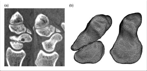 A Image Acquisition A Bilateral Ct Scan Of A Unilateral Scaphoid