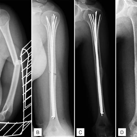 Segmental Comminuted Fracture Of The Humerus In A Morbidly Obese