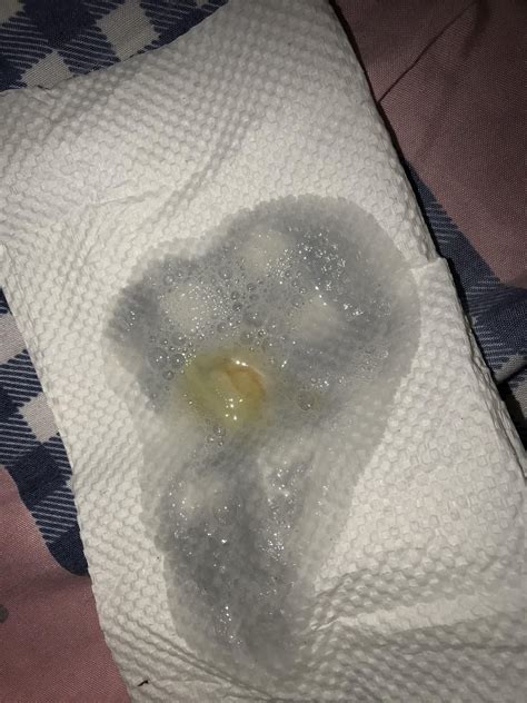 Blood In Phlegm Rasthma