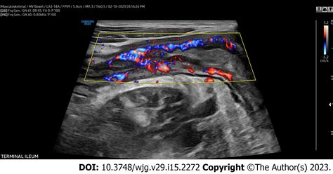 Terminal Ileum Ultrasound