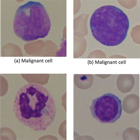 Samples From The Acute Lymphoblastic Leukemia Idb1 Dataset Download
