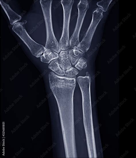 X Ray Wrist Lateral View